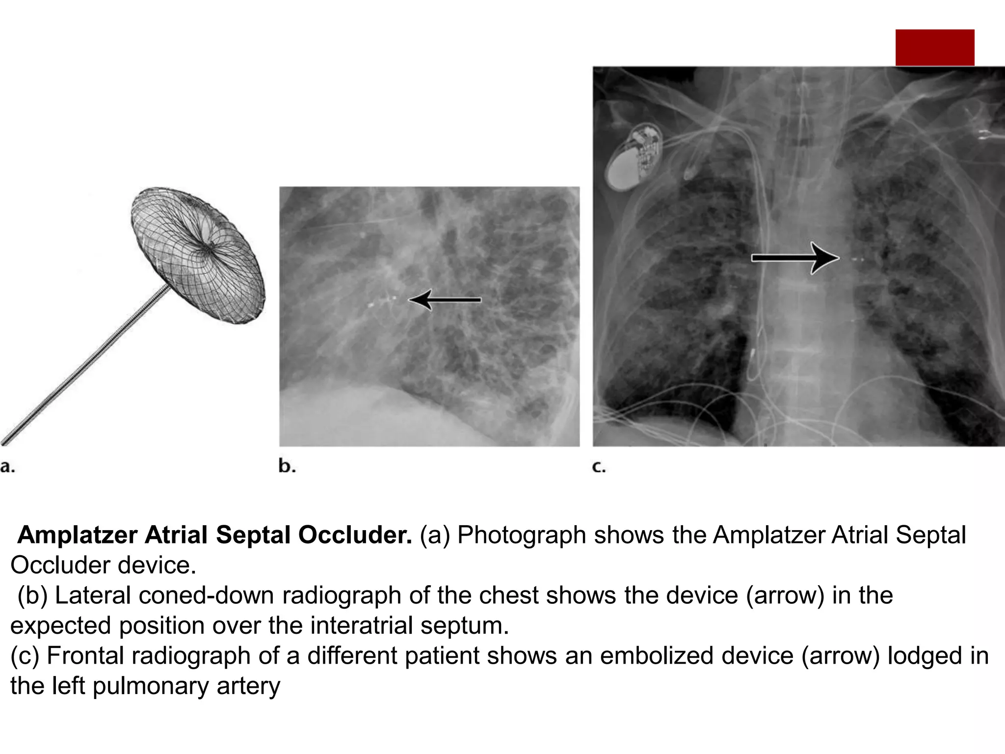 Radiographic Review of Current Therapeutic and Monitoring Devices in ...