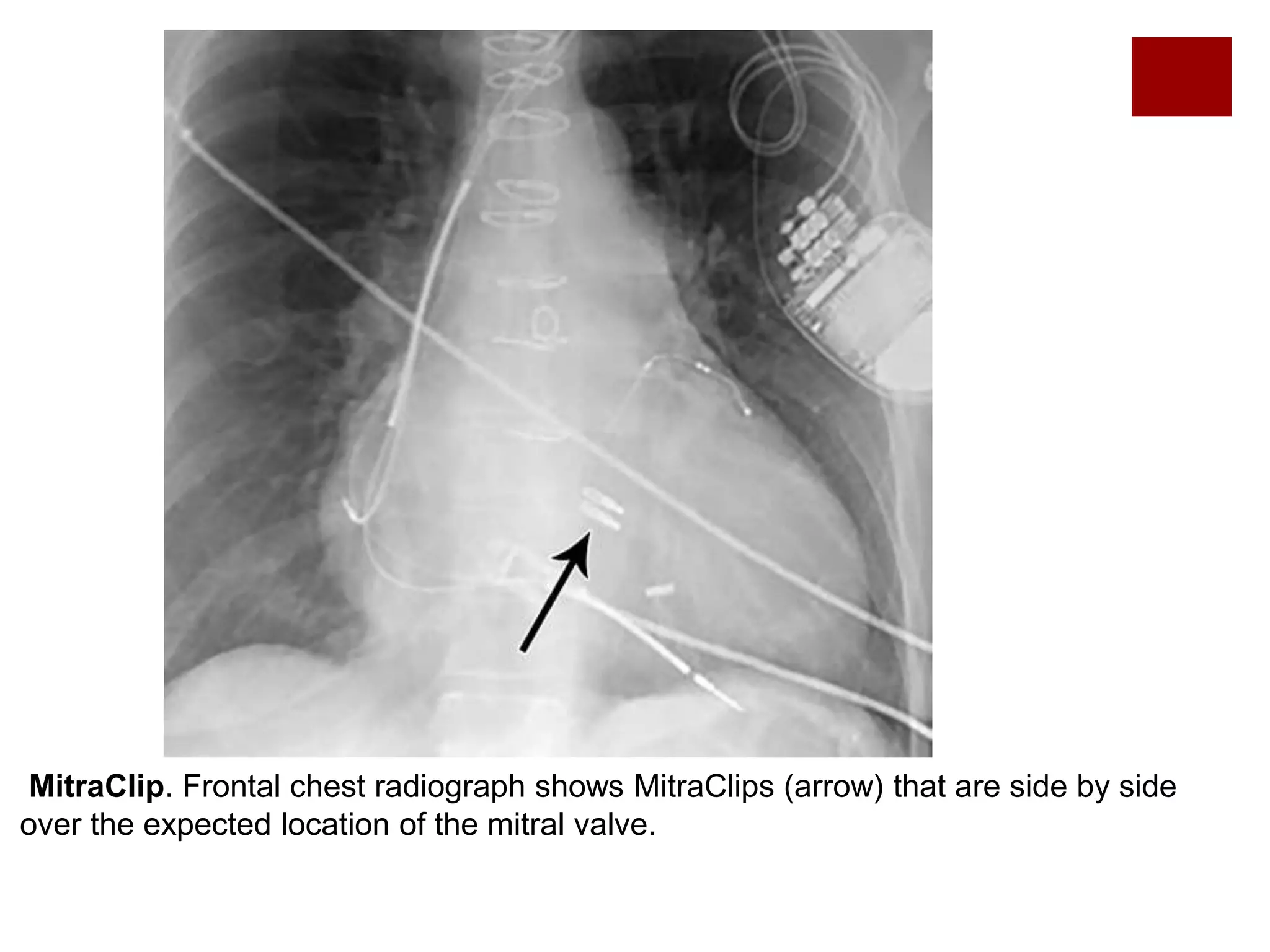 Radiographic Review of Current Therapeutic and Monitoring Devices in ...