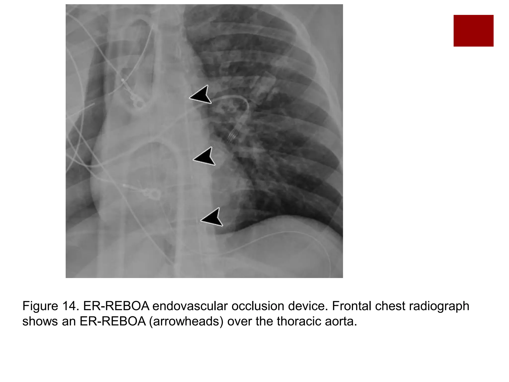 Radiographic Review of Current Therapeutic and Monitoring Devices in ...