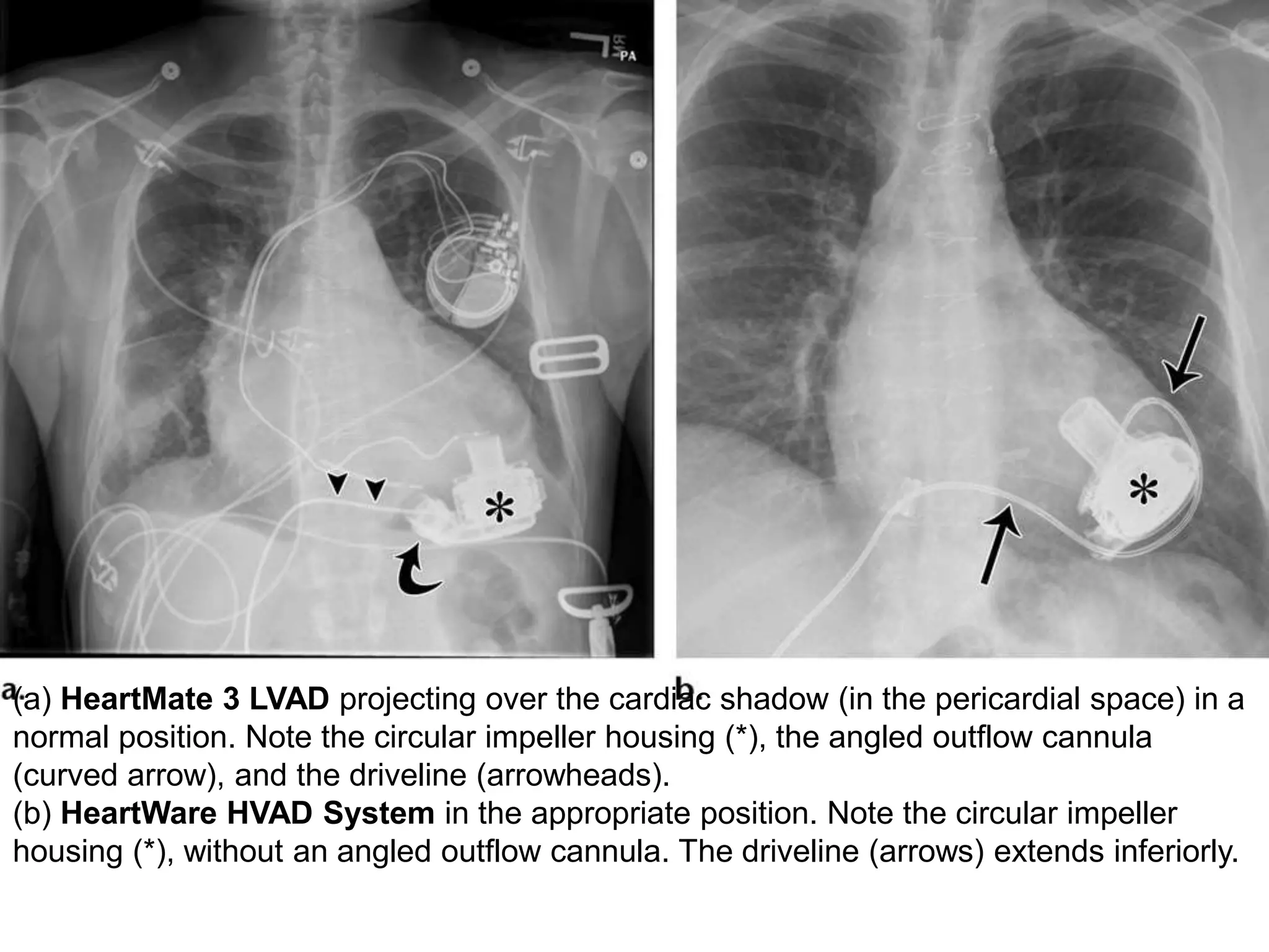 Radiographic Review of Current Therapeutic and Monitoring Devices in ...