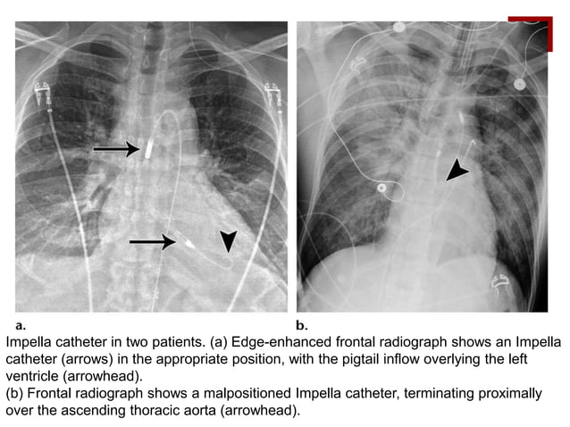 Radiographic Review of Current Therapeutic and Monitoring Devices in ...