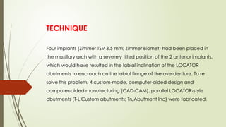 CAD-CAM fabrication of semiprecision LOCATOR-style abutments to correct ...