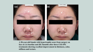 jc scar and laser.pptx journal club scar treatment | PPTX