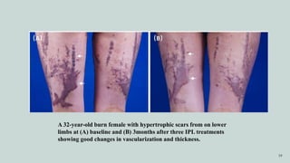 jc scar and laser.pptx journal club scar treatment | PPTX