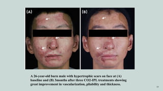 journal club - scar revision with laser and narrowband intensed pulsed ...