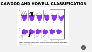 CASE REPORT subperiosteal implants IN DENTISTRY | PPTX