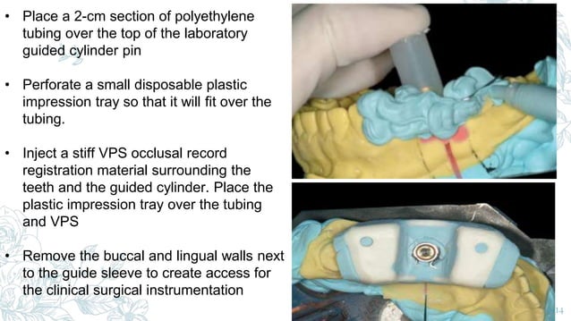 Surgical guide_ journal club | PPT
