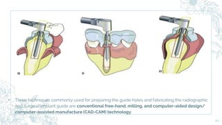 Surgical guide_ journal club | PPTX