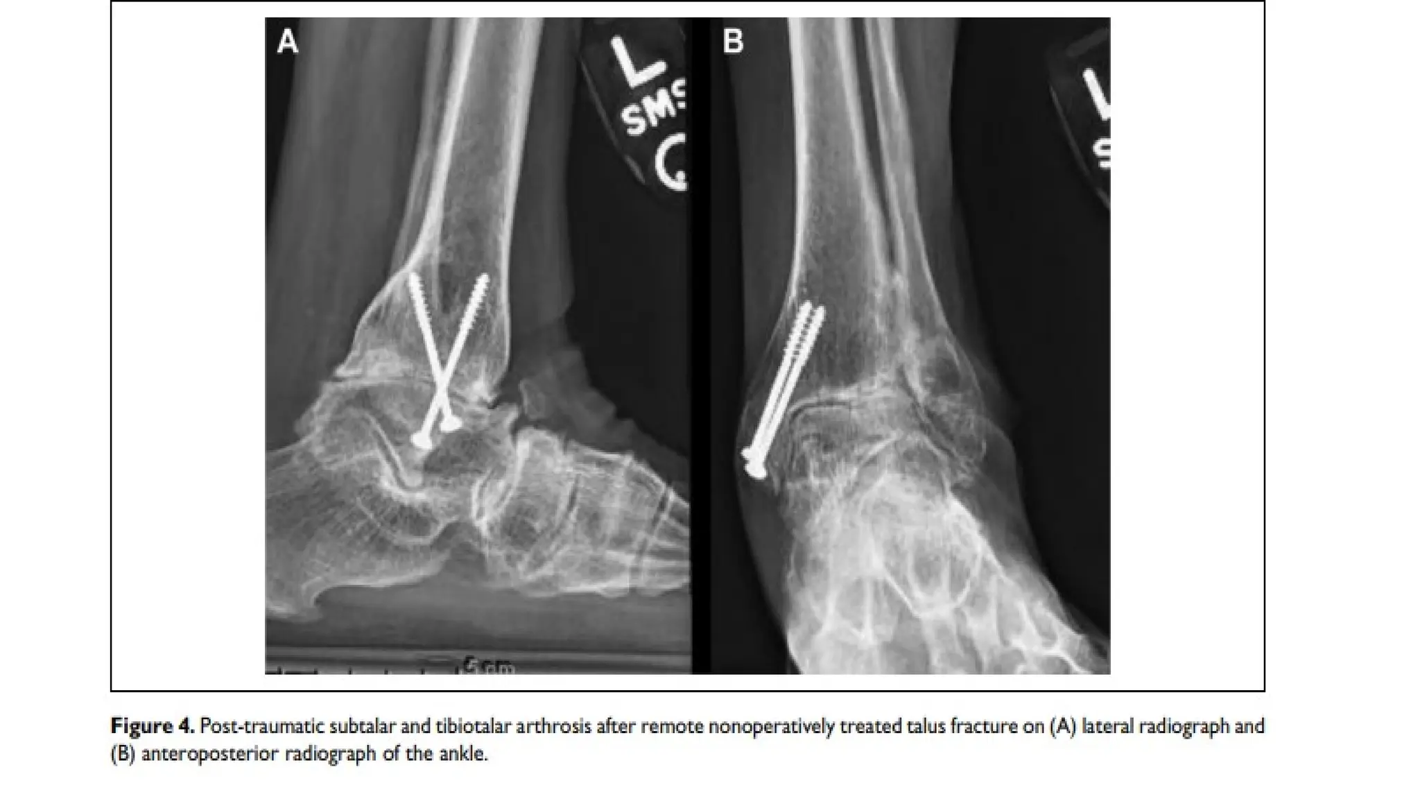 jc talus fracture(2).pptxgrrrrrrrrgrrrrrghrrgrgrrrg | PPTX