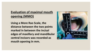 jounal club iprf to temporomandibular joint | PPTX