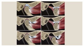 jounal club iprf to temporomandibular joint | PPT