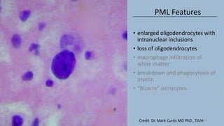 Pathology of JC Virus | PPTX