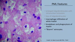 Pathology of JC Virus | PPTX