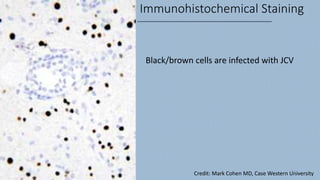 Pathology of JC Virus | PPTX