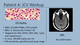 Pathology of JC Virus | PPTX
