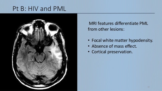 Pathology of JC Virus