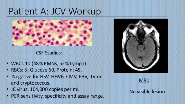 Pathology of JC Virus
