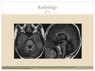 JC Virus Granule Cell Neuronopathy.pptx . | PPTX