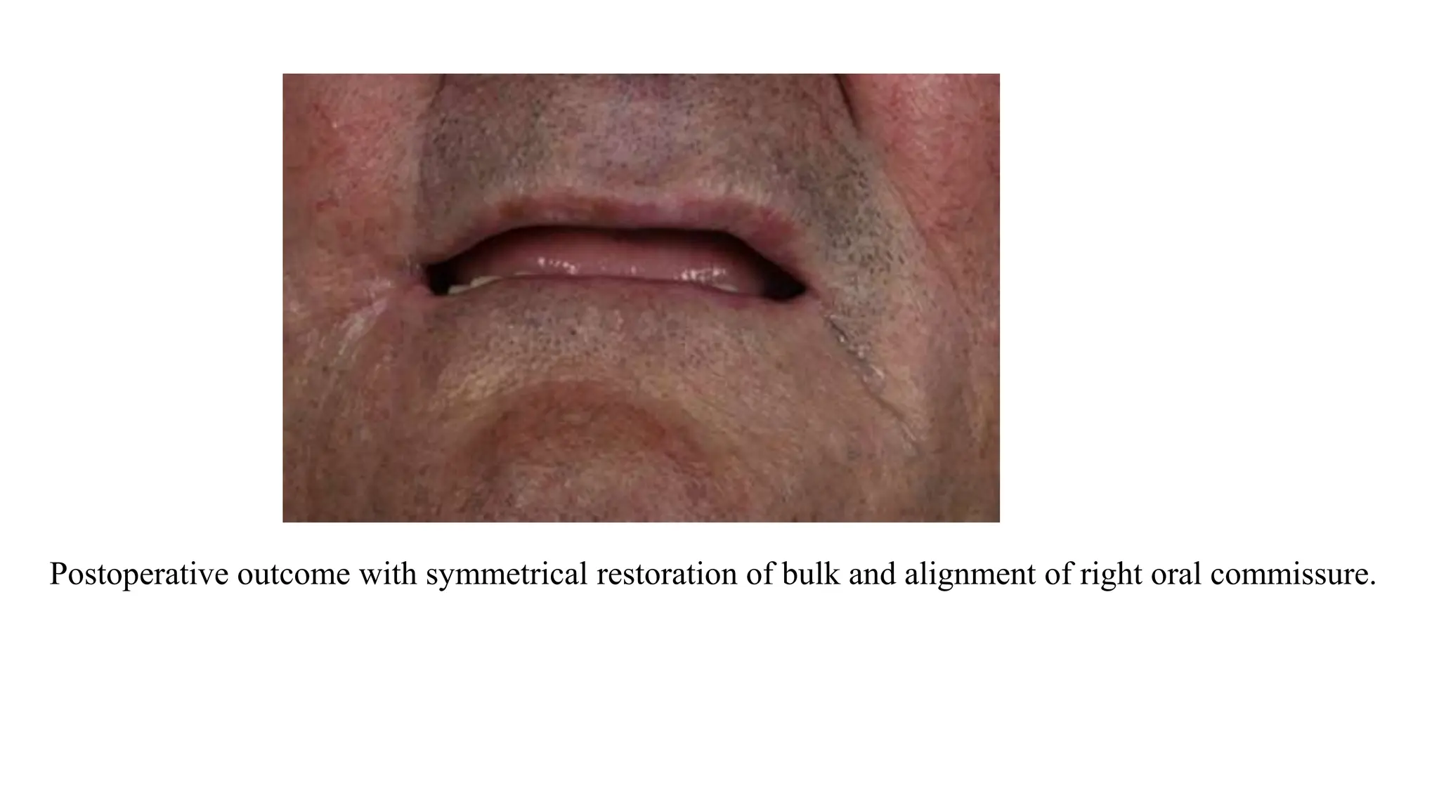 JC ZISSER FLAP.pptx oral and maxillofacial surgery | PPTX