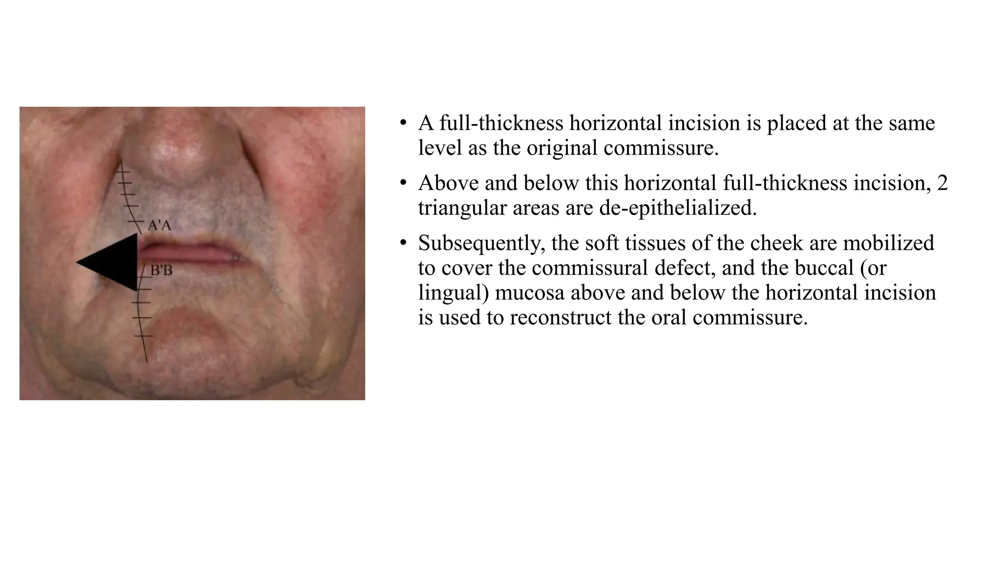 JC ZISSER FLAP.pptx oral and maxillofacial surgery | PPTX