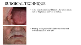 JC ZISSER FLAP.pptx oral and maxillofacial surgery | PPTX
