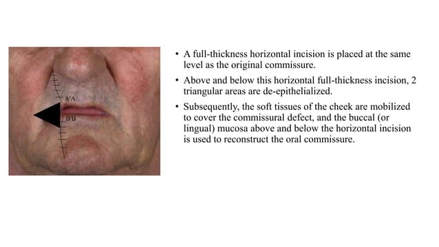 JC ZISSER FLAP.pptx oral and maxillofacial surgery | PPTX