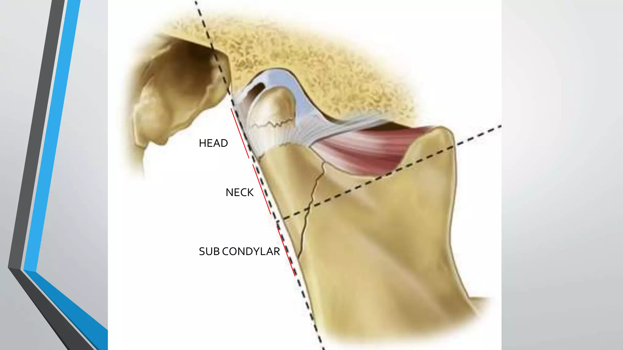 open versus closed reduction of adult condylar fracture | PPTX