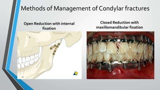 open versus closed reduction of adult condylar fracture | PPT