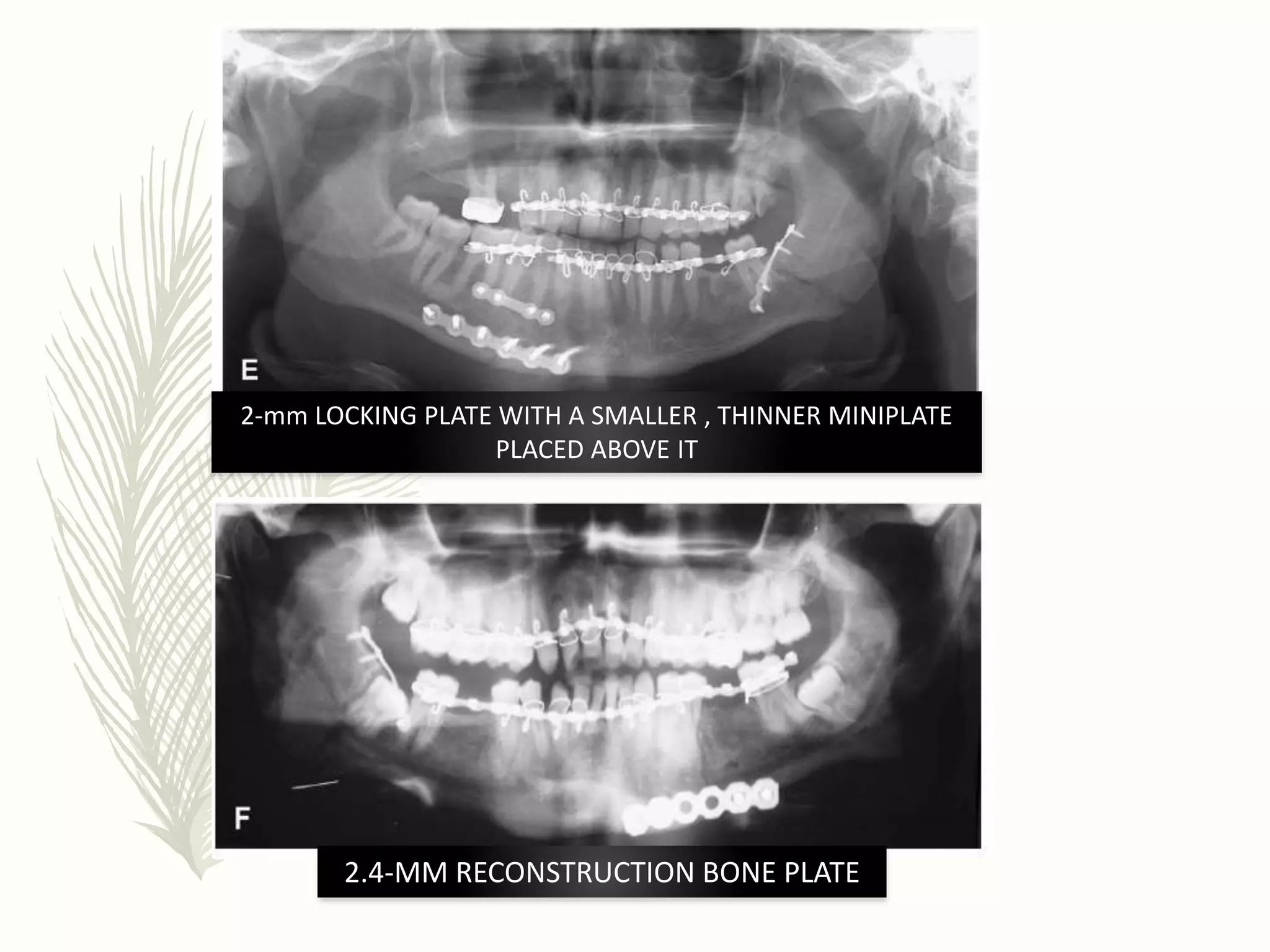 OPEN REDUCTION AND INTERNAL FIXATION OF COMBINED ANGLE AND BODY ...