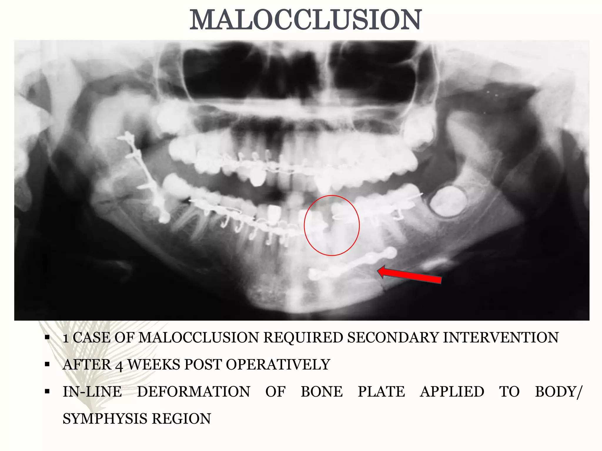 OPEN REDUCTION AND INTERNAL FIXATION OF COMBINED ANGLE AND BODY ...