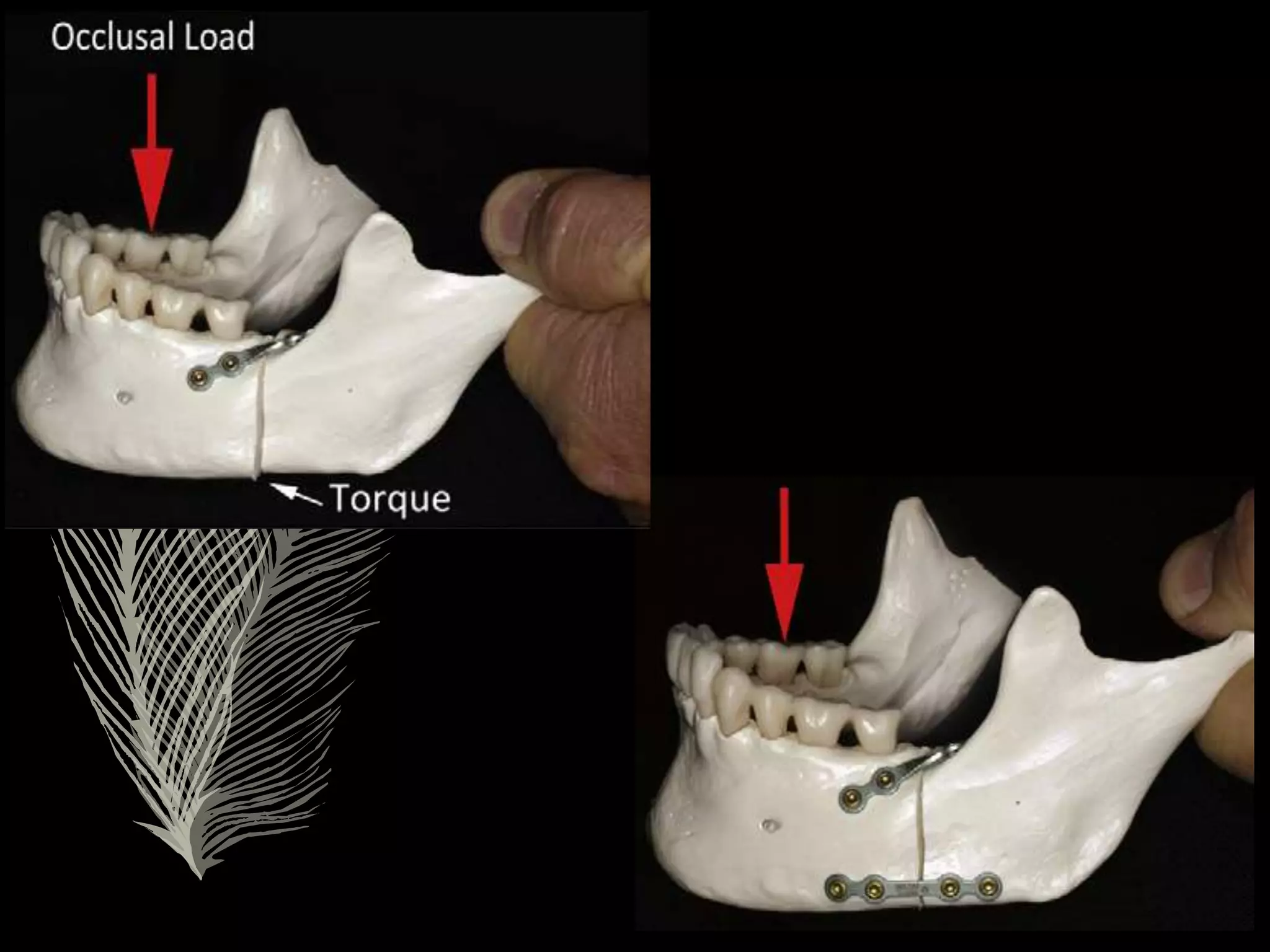 OPEN REDUCTION AND INTERNAL FIXATION OF COMBINED ANGLE AND BODY ...