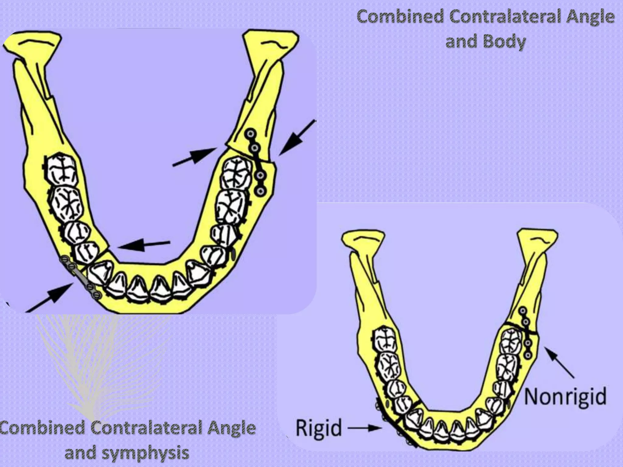 OPEN REDUCTION AND INTERNAL FIXATION OF COMBINED ANGLE AND BODY ...
