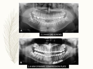 OPEN REDUCTION AND INTERNAL FIXATION OF COMBINED ANGLE AND BODY ...