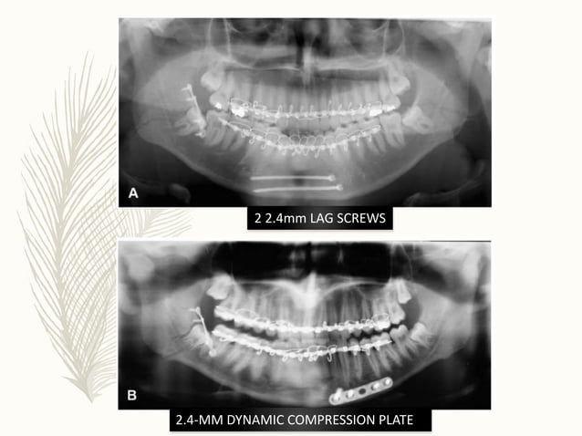 OPEN REDUCTION AND INTERNAL FIXATION OF COMBINED ANGLE AND BODY ...