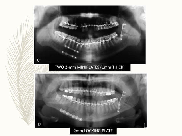 OPEN REDUCTION AND INTERNAL FIXATION OF COMBINED ANGLE AND BODY ...