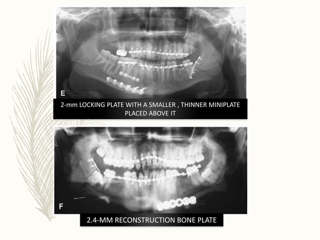 OPEN REDUCTION AND INTERNAL FIXATION OF COMBINED ANGLE AND BODY ...