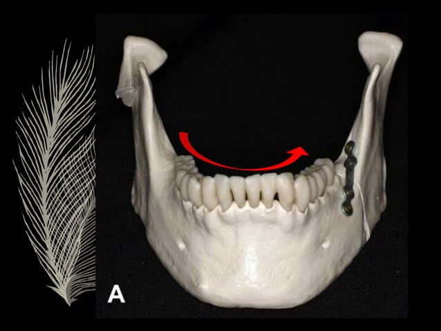 OPEN REDUCTION AND INTERNAL FIXATION OF COMBINED ANGLE AND BODY ...
