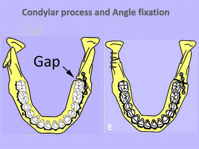 OPEN REDUCTION AND INTERNAL FIXATION OF COMBINED ANGLE AND BODY ...