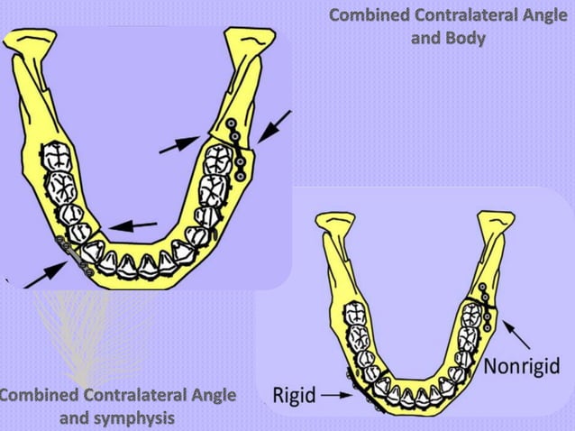 OPEN REDUCTION AND INTERNAL FIXATION OF COMBINED ANGLE AND BODY ...