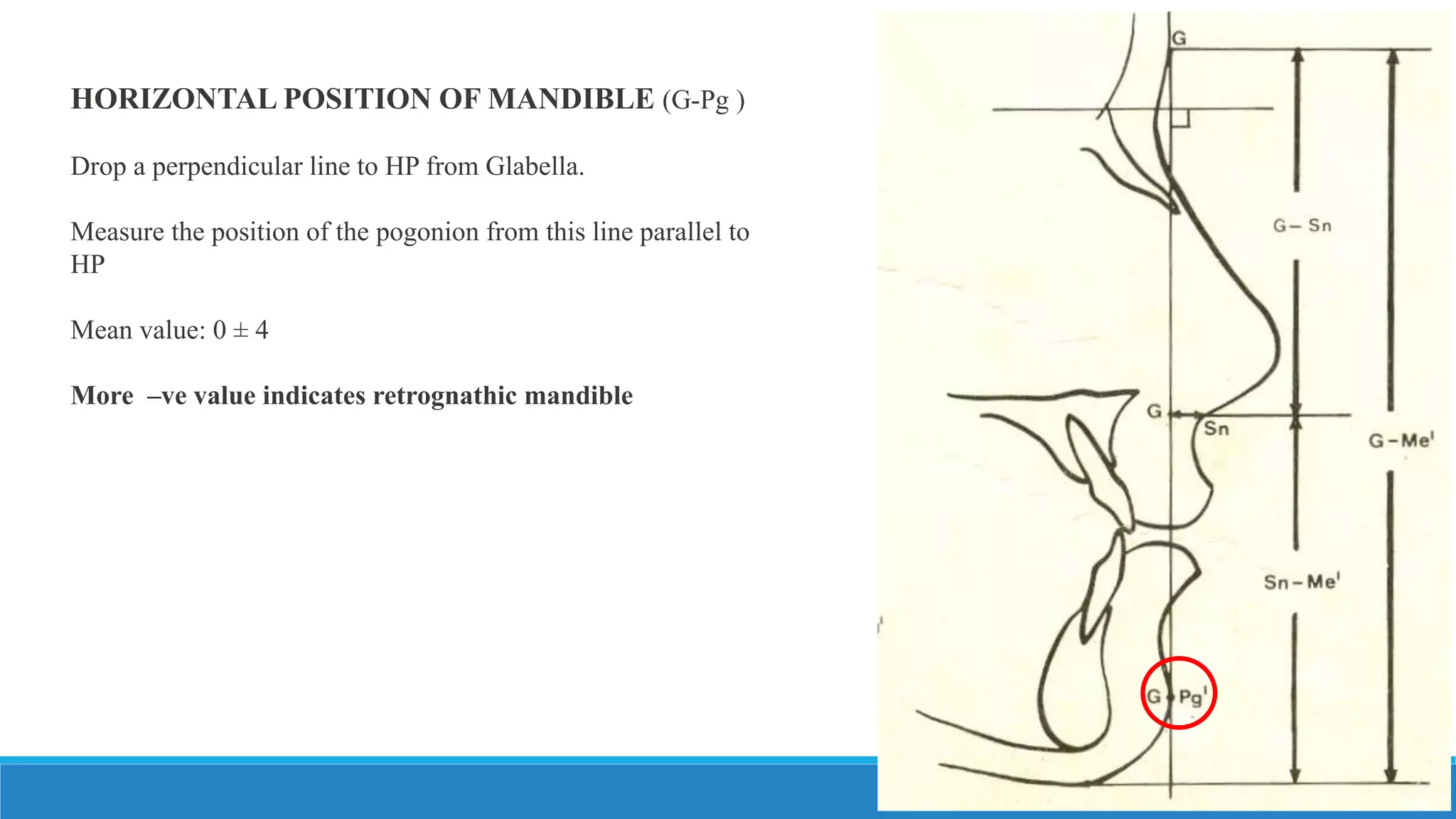 COGS Burstone analysis for orthognathic surgery | PPTX