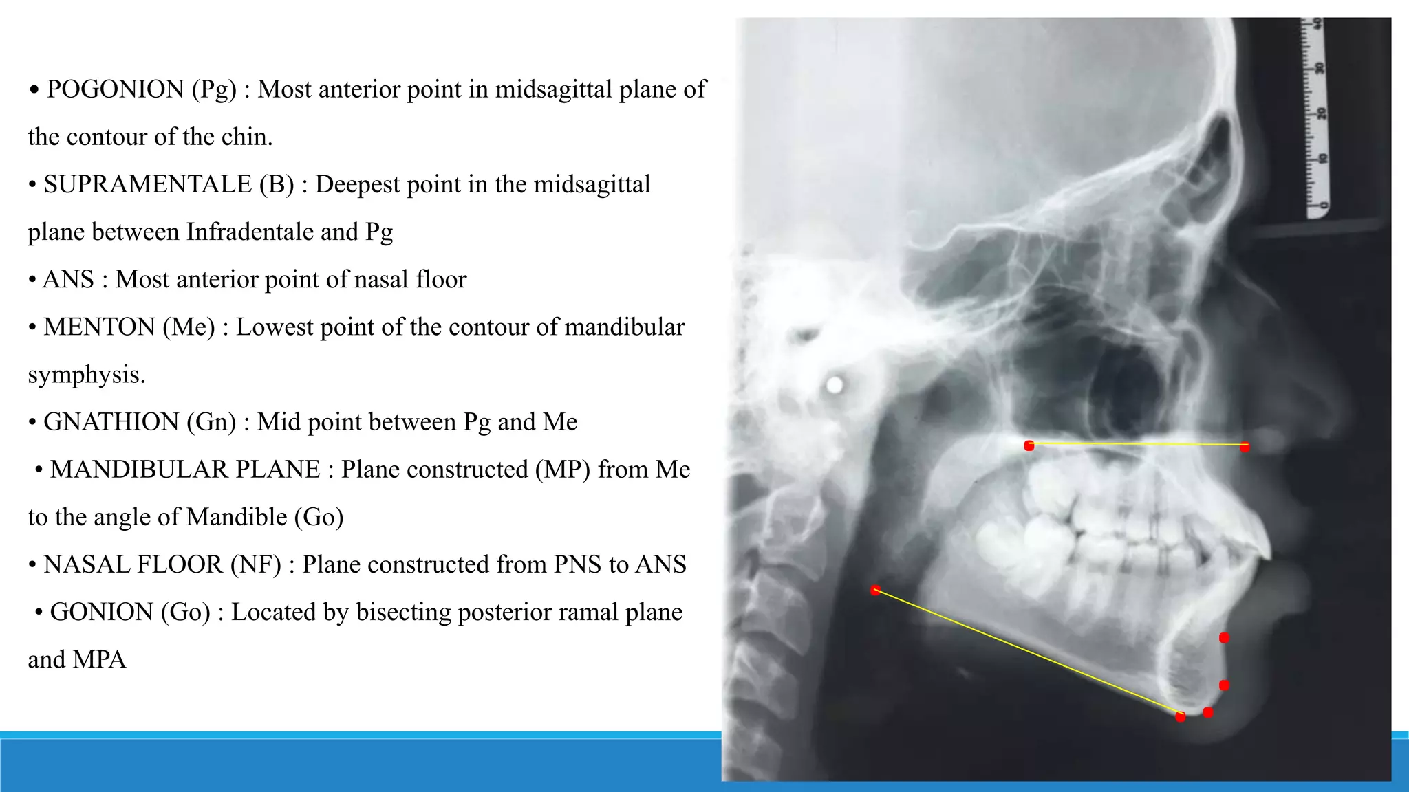 COGS Burstone analysis for orthognathic surgery | PPTX
