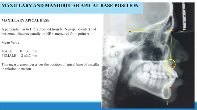 COGS Burstone analysis for orthognathic surgery | PPTX