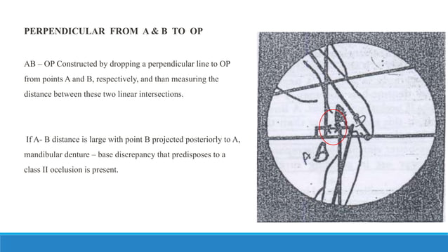 COGS Burstone analysis for orthognathic surgery | PPTX