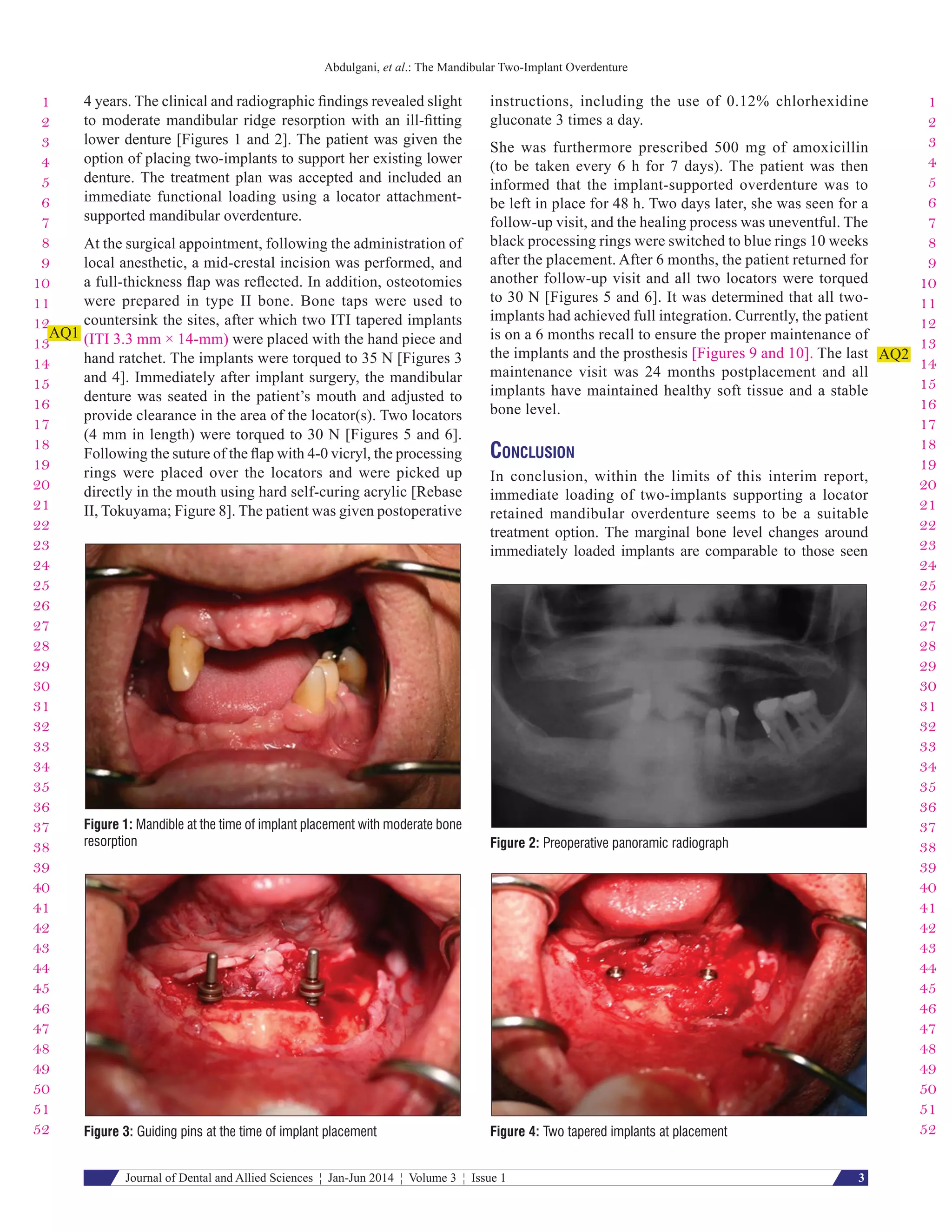 The Mandibular Two-Implant Overdenture | PDF