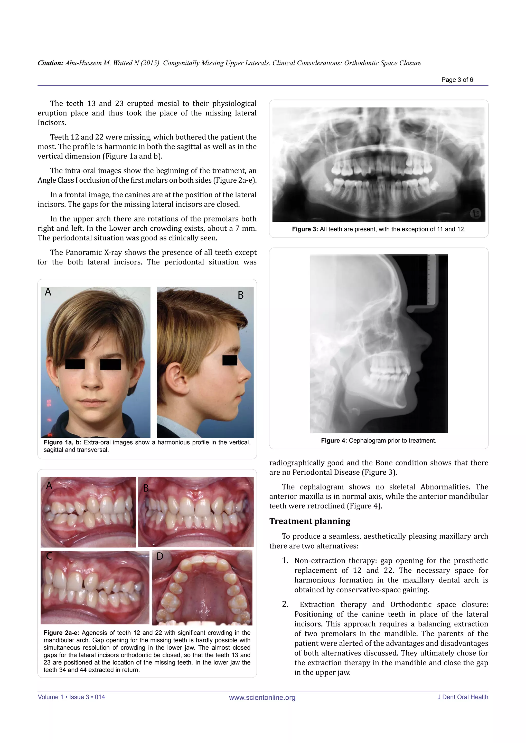 Congenitally Missing Upper Laterals. Clinical Considerations ...
