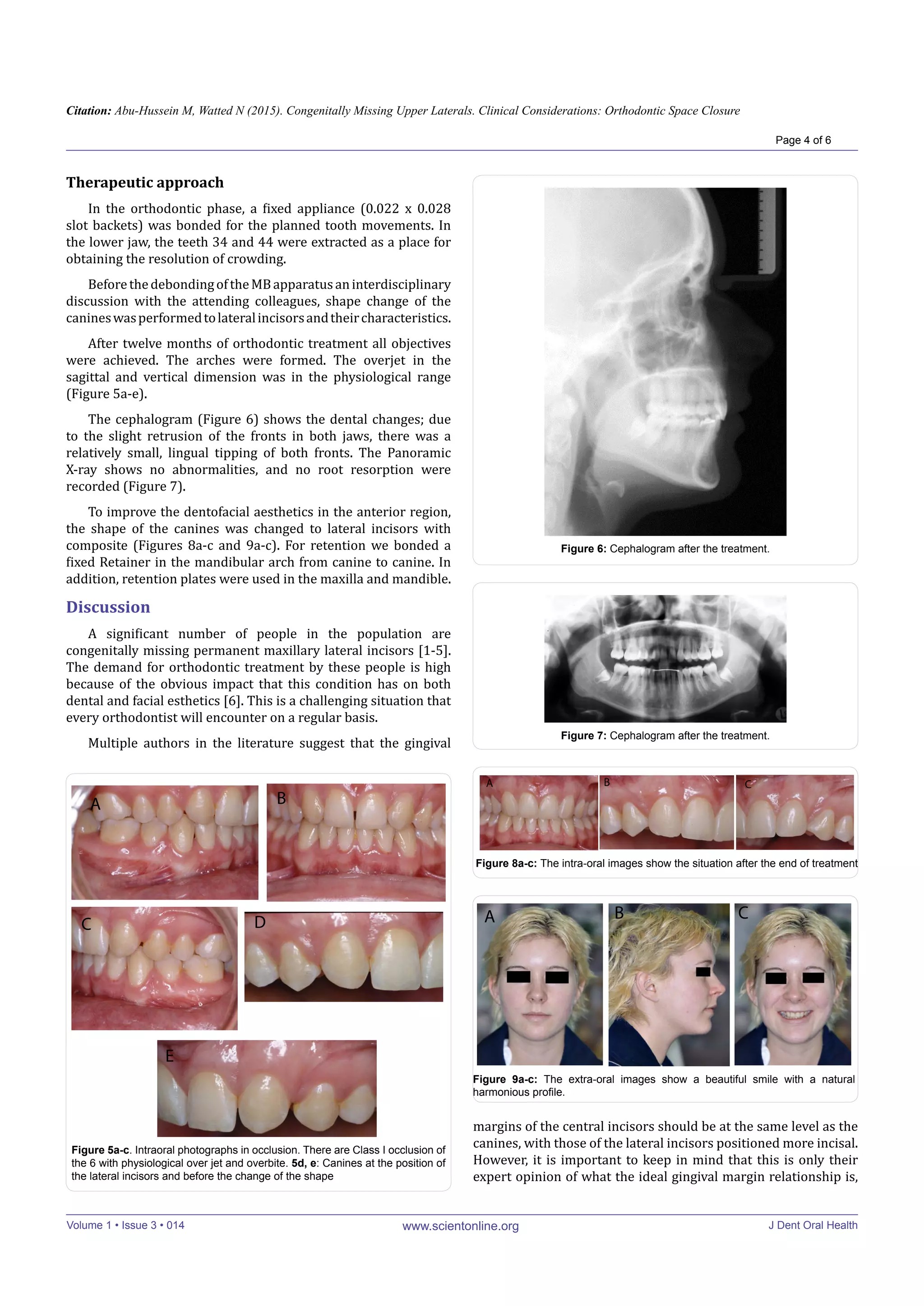 Congenitally Missing Upper Laterals. Clinical Considerations ...