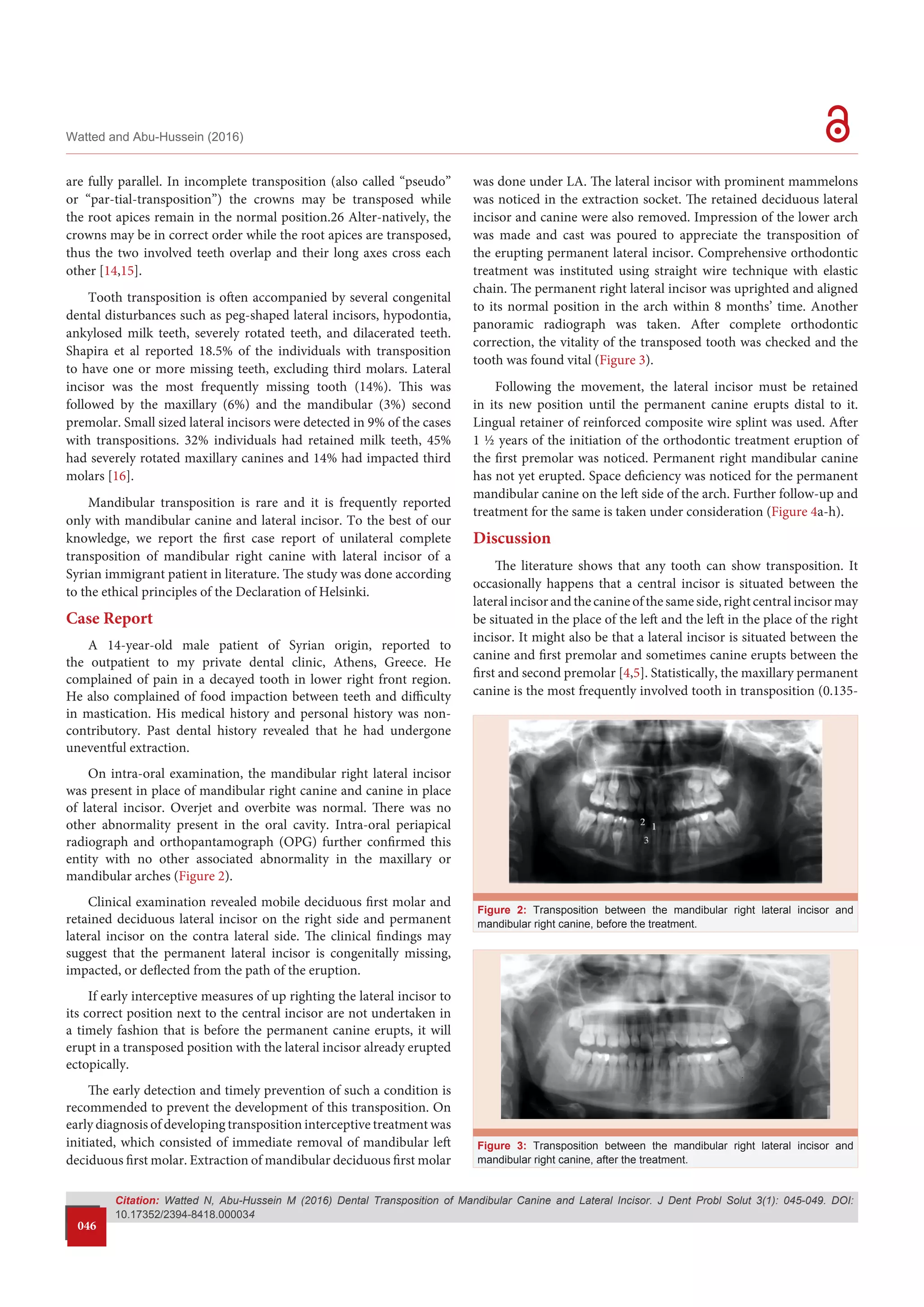 Dental Transposition of Mandibular Canine and Lateral Incisor | PDF