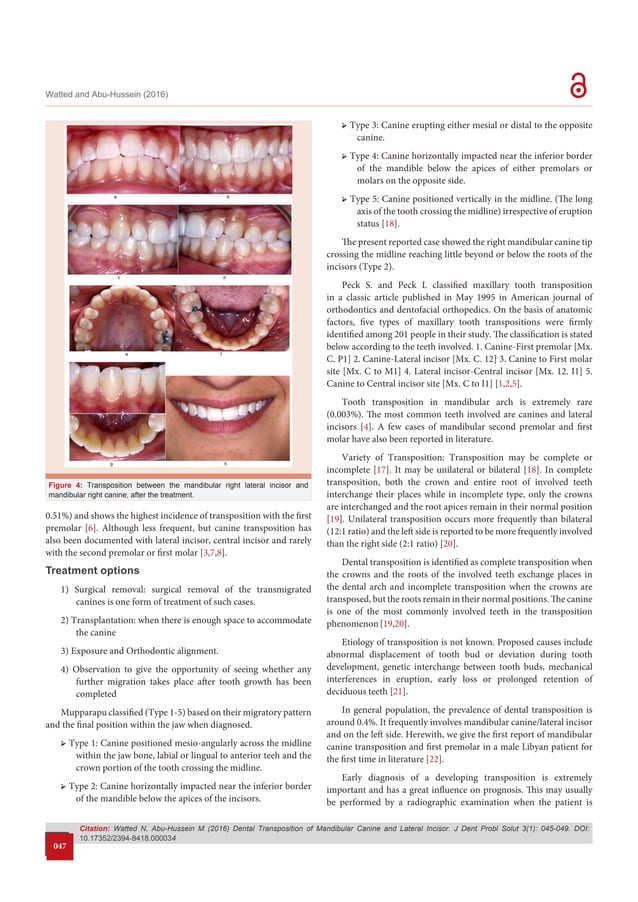 Dental Transposition of Mandibular Canine and Lateral Incisor | PDF