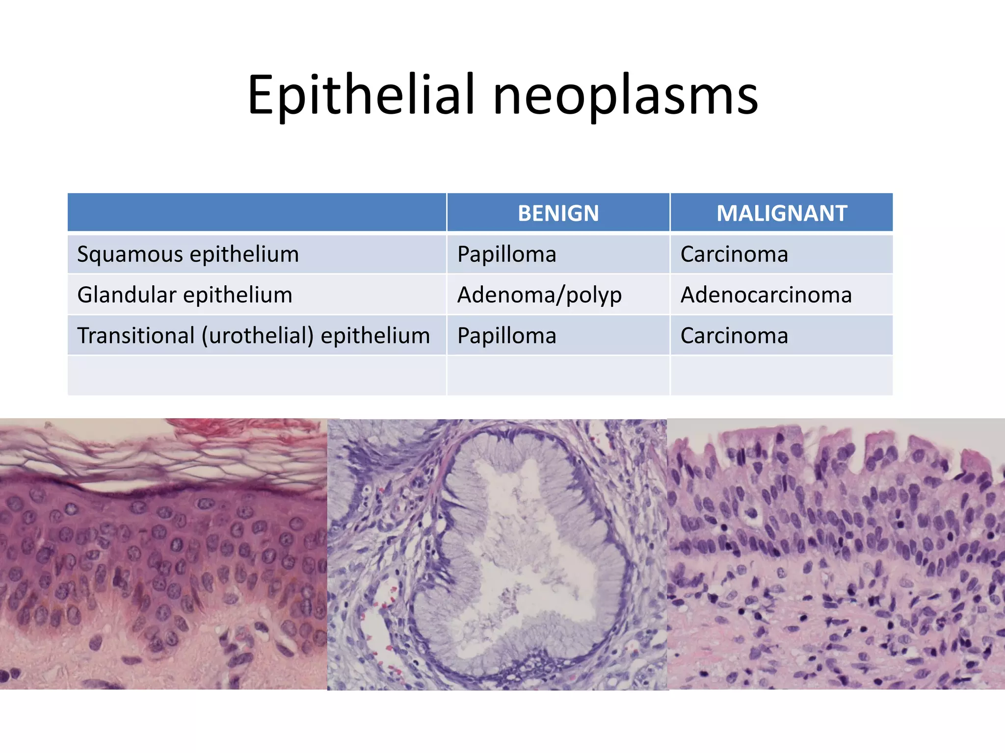 Epithelial neoplasms | PDF