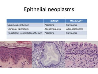 Epithelial neoplasms | PDF
